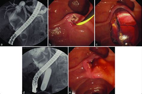 A Case Of Large Balloon Dilation After Minor Endoscopic Biliary Download Scientific Diagram