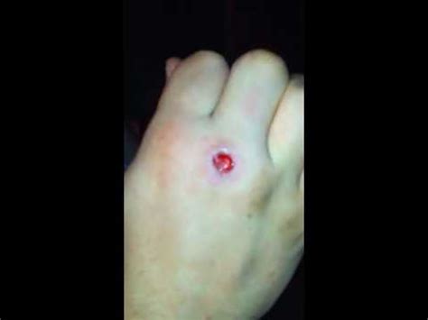 Cut Open Knuckle You Can See The Tendon YouTube