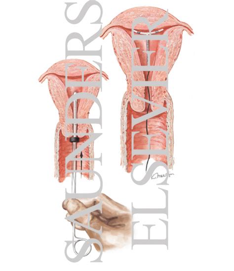 Intrauterine Contraceptive Device Iucd Insertion