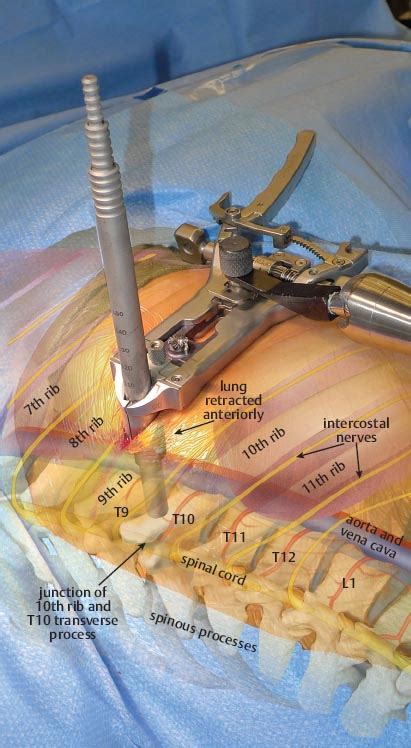 Minimally Invasive Thoracic Corpectomy Neupsy Key