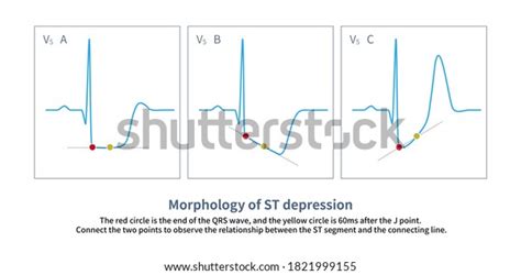 When St Segment Depressed Amplitude Depression Stock Illustration Shutterstock