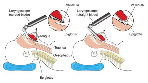 Intubation Overview And Practice Questions
