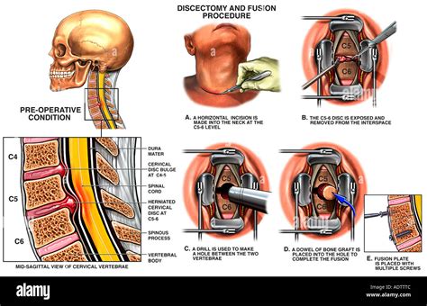 Herniated Cervical Disc Treatment Options At Bennie Morris Blog