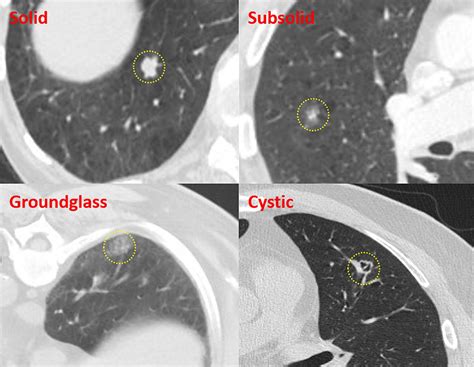 Ct Guided Injection Of 99mtc Maa For Lung Nodule Localization Prior To Vats Clinical Imaging