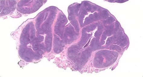 Tonsil Normal Histology Nus Pathweb Nus Pathweb