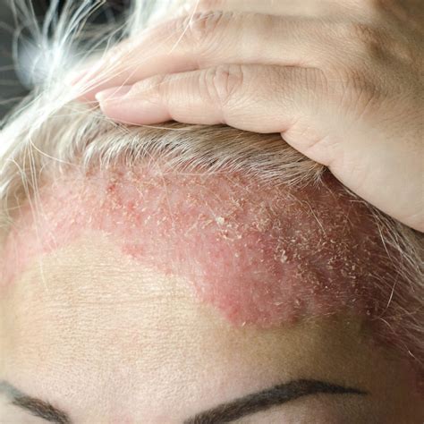 Truly You Scalp Disorder Treatment In Mississauga