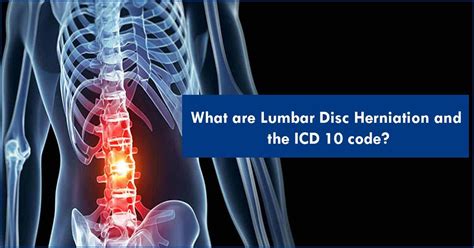 Other Intervertebral Disc Displacement Lumbar Region 56 Off