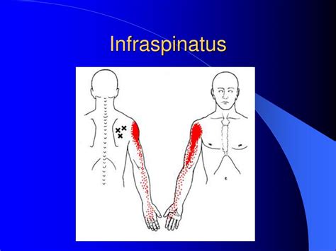 Ppt Trigger Point Workshop Powerpoint Presentation Free Download Id 218879