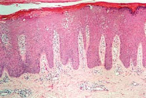 Histologia Da Psoriase Eritrodermica