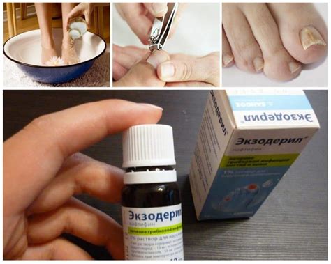 Лак от грибка ногтей на ногах список лучших средств против онихомикоза цена и отзывы