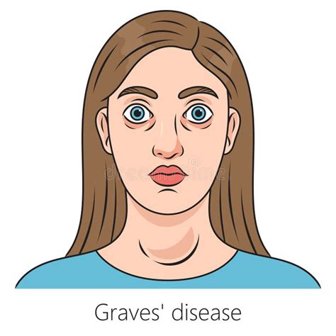Woman With Graves Disease Medical Science Stock Vector Illustration Of Structure Isolated