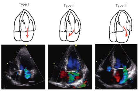 Cardinfo Echocardiography Mitral Regurgitation