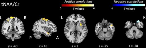 Regional Associations Of Reduced Functional Connectivity With Primary Download Scientific