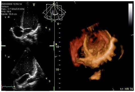 Real Time Three Dimensional Echocardiography And Two Dimensional Download Scientific Diagram