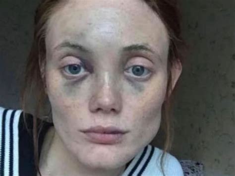Esta Modelo De Vogue Fue Golpeada Por Su Novio Y Nos Recuerda Que Todas