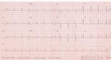 St Segment Elevation In D2 D3 And Avf Derivations Reciprocal St Download Scientific Diagram