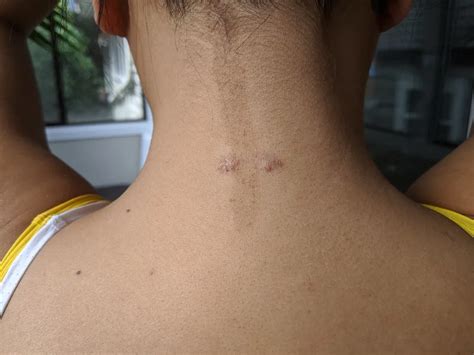 My Keloid Treatment Journey Using Kenalog Schimiggy Reviews