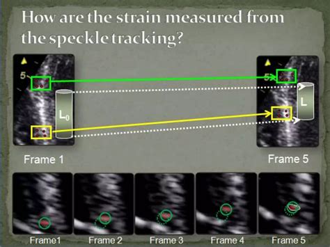 Speckle Tracking Echocardiography Pptx