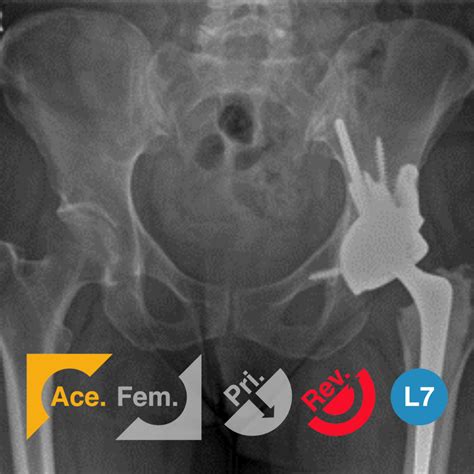 Case 42 Next Generation 3d Printed Cup For Severe Acetabular Osteolysis And An Intact Bony Rim