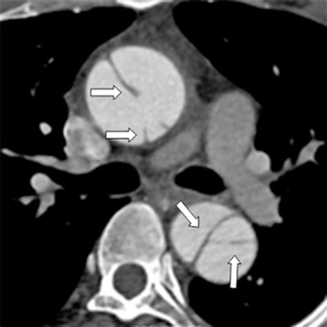 Multiple Line Type Of The Intimal Flap On An Axial Ct Image Download Scientific Diagram