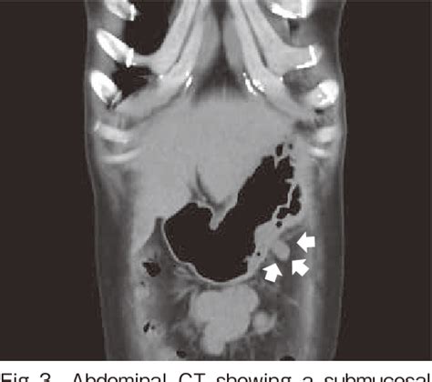 Figure 1 From A Case Report Of Gastric Duplication Treated By Laparoscopic Resection Semantic