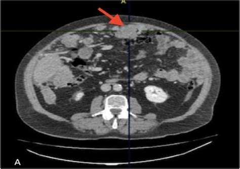 A Axial Section Of Primary Serous Carcinoma Of The Peritoneum In A Download Scientific Diagram
