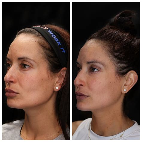 Jawline Contouring Before And After Kaado Md Aesthetics And Anti Aging