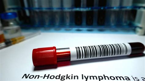Lymphoma Symptoms Diagnosis And Treatment Options For The Common Cancer Fox News