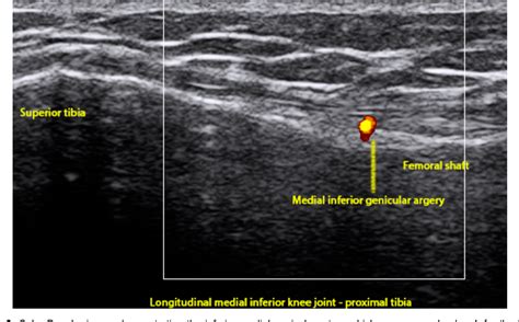 Ultrasound Guided Genitofemoral Nerve Block Agaclip Ultrasound Guided Genitofemoral Nerve Block Agaclip