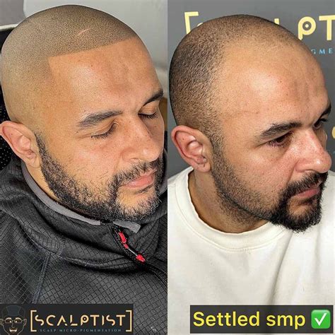 How Long Does Scalp Micropigmentation Last On Average In 2025 Scalp