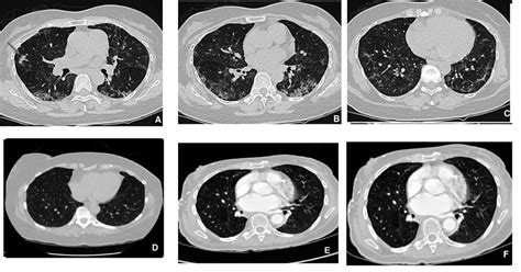 Deep Convolutional Neural Network Based Computer Aided Detection