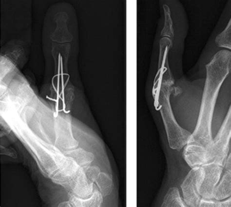 Mcp Joint Arthritis Hand Orthobullets