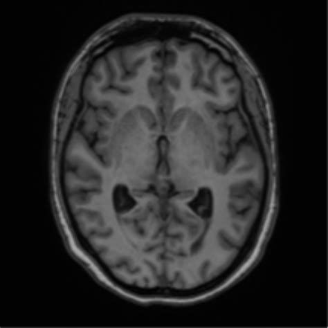 Cavernoma With Bleed Midbrain Radiopaedia 54546 60774 Axial T1 Nc