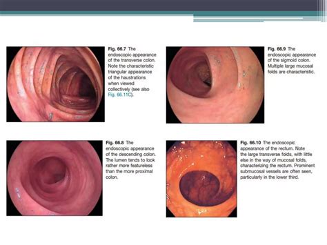 Бүдүүн гэдэсний хорт хавдар Pptx