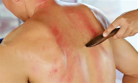 Osteoporosis For Glendale And Milwaukee Wi Rheumatic Disease Center Rheumatologists