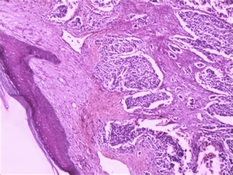 Photomicrograph Showing Surface Squamous Epithelium Subepithelial Download Scientific Diagram
