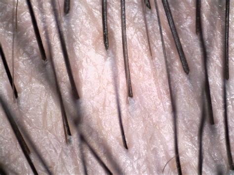 Dino Lite Digital Microscopes In Scalp Dermatology Dino Lite Singapore