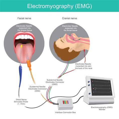 Premium Vector Electromyography A Technique Medical Use For Assessing And Recording
