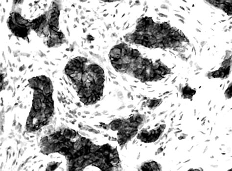 Expression Of P Cadherin But Not E Cadherin Or N Cadherin Relates To