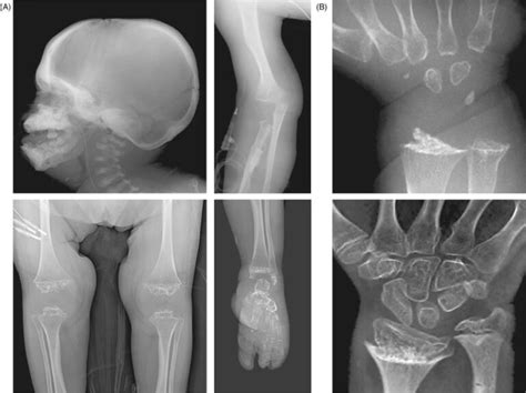 Hyperthyreose Den Skjulte Trussel Mod Knoglerne Mednote