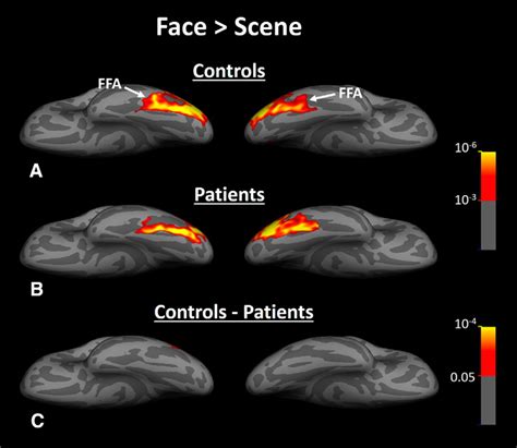 Impact Of Visual Corticostriatal Loop Disruption On Neural Processing Within The Parahippocampal