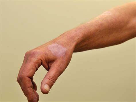 Melanoma Associated Leukoderma Mal