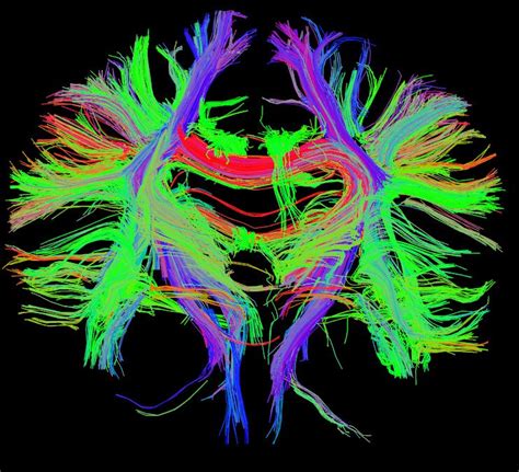 Corpus Callosum Imaging — Tom Gillette