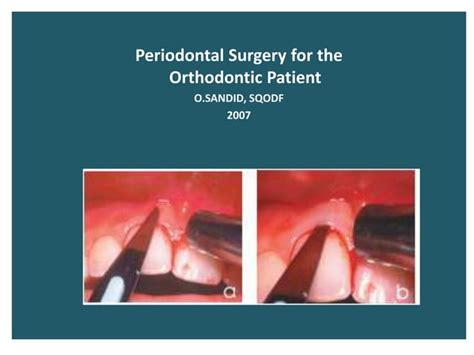 Interdisciplinary Treatment In Orthodontics Dr Olivier Sandid