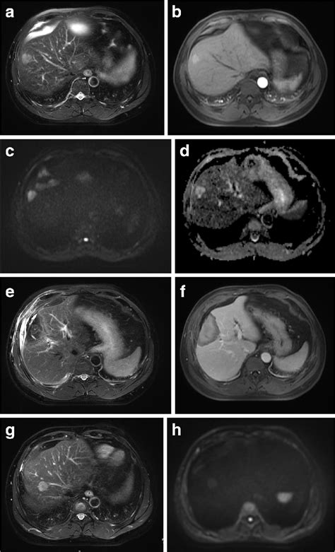 A 55 Year Old Man With A 25 Cm Single Hepatocellular Carcinoma Hcc