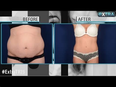 Video Diary See The Dramatic Results Of This Mommy Makeover Youtube