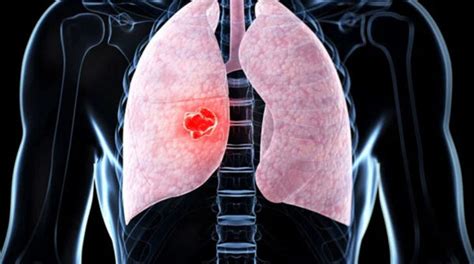 Nódulo Pulmonar Qué Es Síntomas Recomendaciones Atención Méd