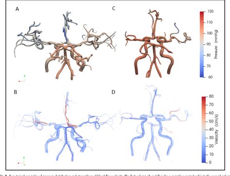 Figure 2 From Evaluation Of Cerebrovascular Hemodynamics In Vascular Dementia Patients With A