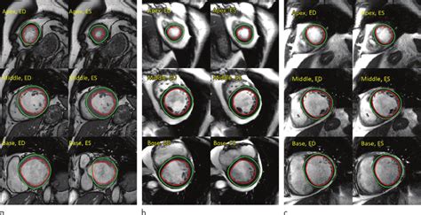 Examples Of Automated Left Ventricular Segmentation From Convolutional Download Scientific