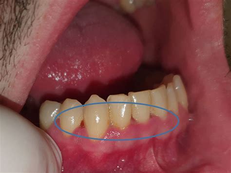 Necrotizing Ulcerative Gingivitis Titsinides Savvas Oral Medicine Oral Surgery Specialist